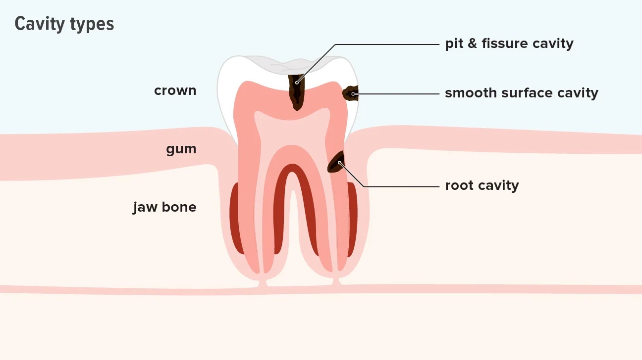 How to Protect Teeth from Cavity Growing and Getting Worse?