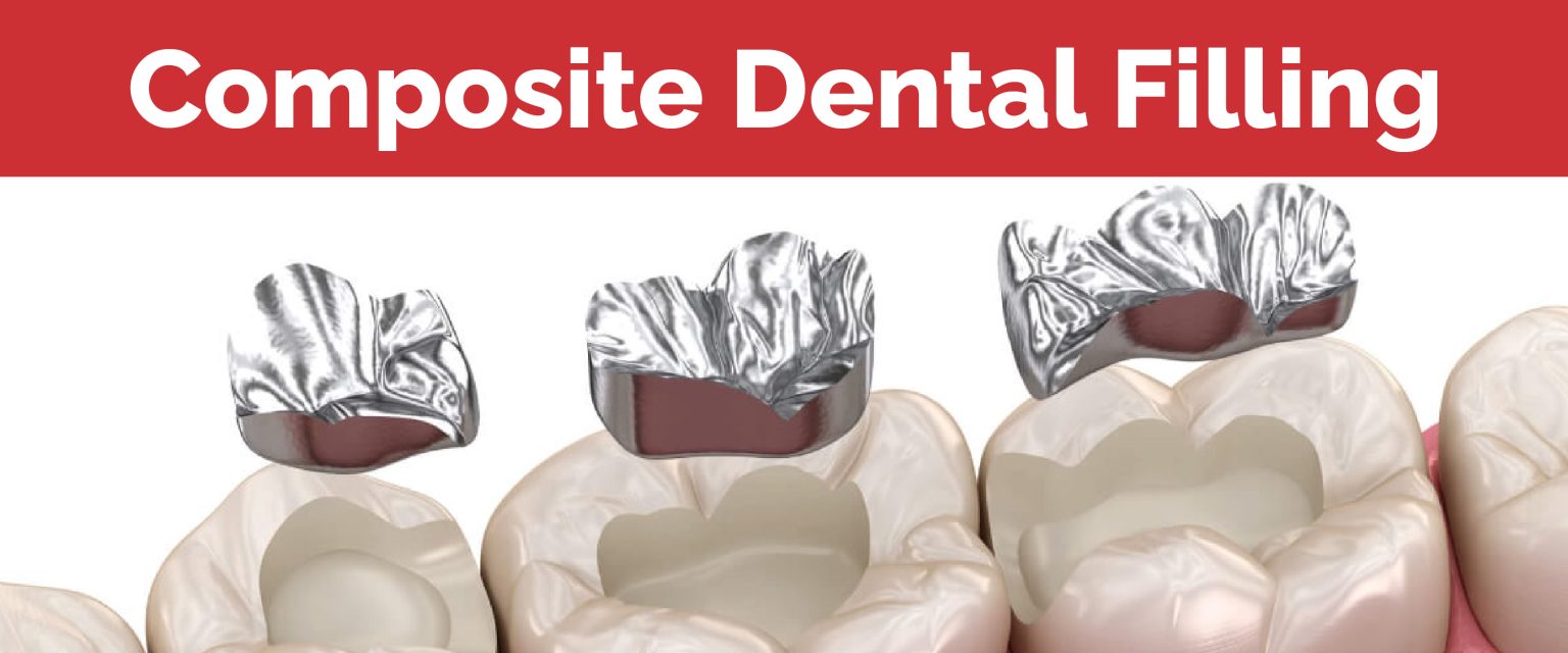 What is a Composite Filling: How it is Done & Take Care of it?